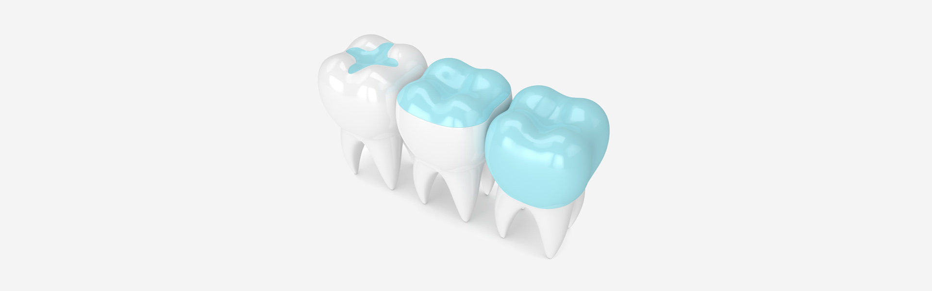 A Guide to Dental Inlays and Onlays: All You Need to Know